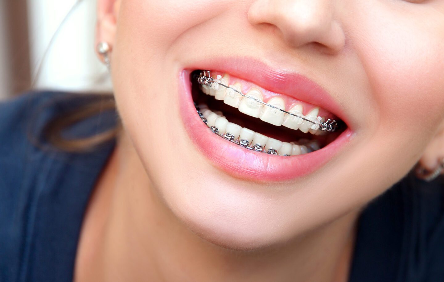 Affordable Clear Ceramic Braces in NJ for a Radiant Smile - MyOrthodontist